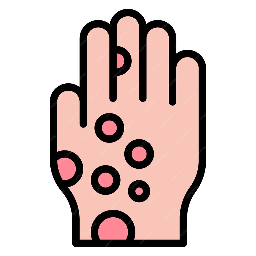 Eritema Palmar, primeiro indício de uma nova Dermatose ocupacional ...